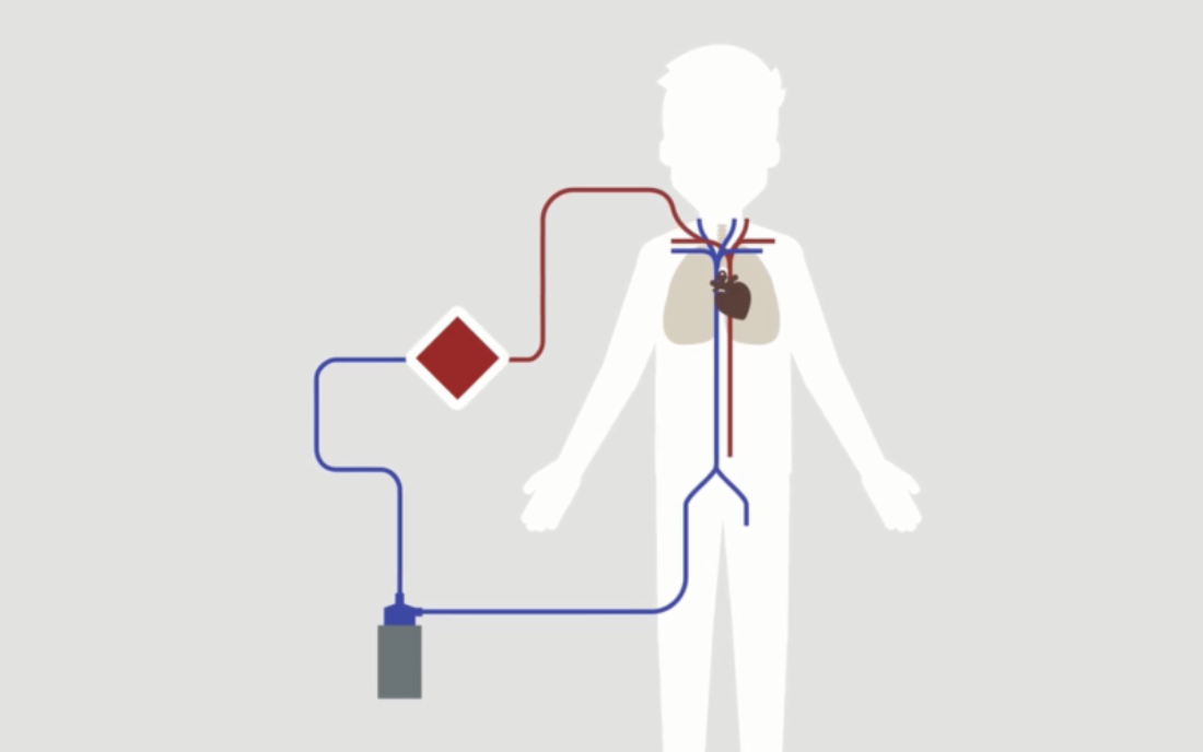 El 'milagro' del sistema de ventilación mecánica ECMO - Con I de ...