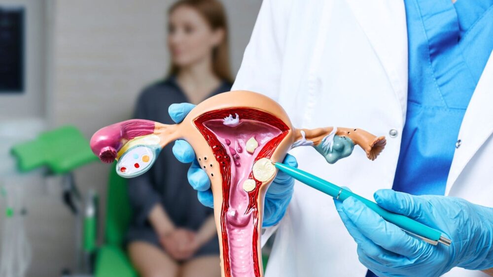 Todo lo que debes saber de los miomas uterinos - Con I de Intelligente