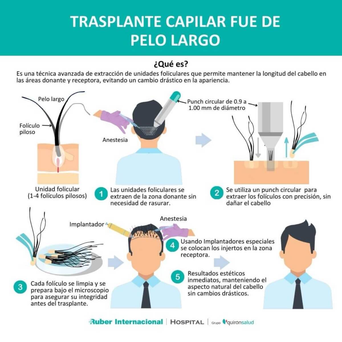 Así es la innovadora y efectiva técnica FUE de trasplante capilar - Con I de Intelligente
